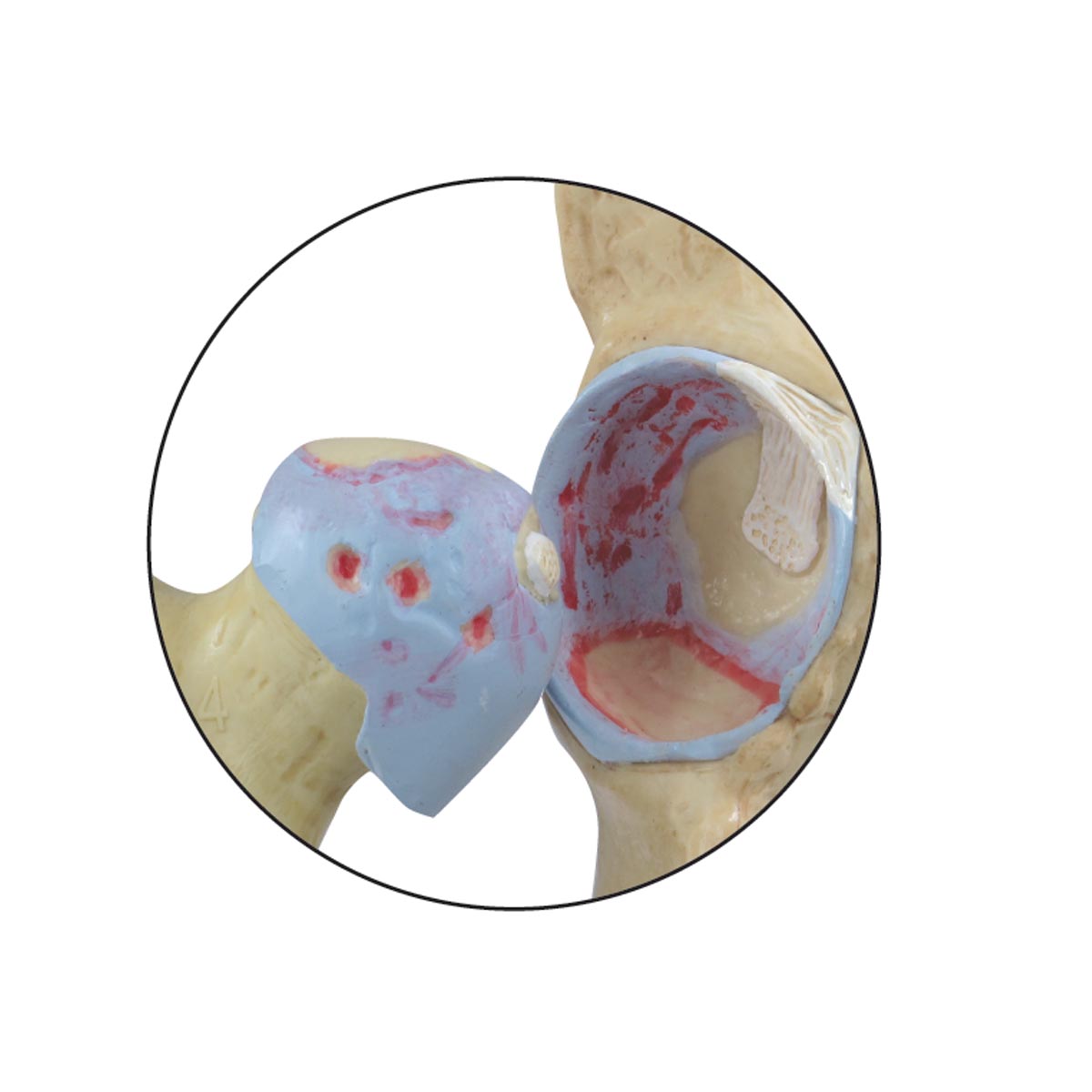 4-Stage Degenerative Bone Diseases of the Hip Model - SEM Trainers