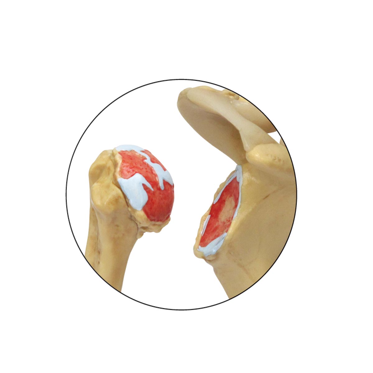 4 Stage Osteoarthritis (OA) Shoulder Model - SEM Trainers