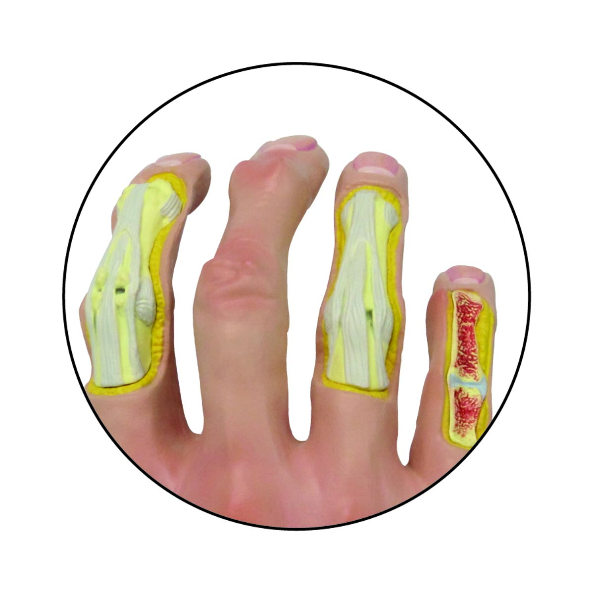 Osteoarthritis Hand Model - SEM Trainers