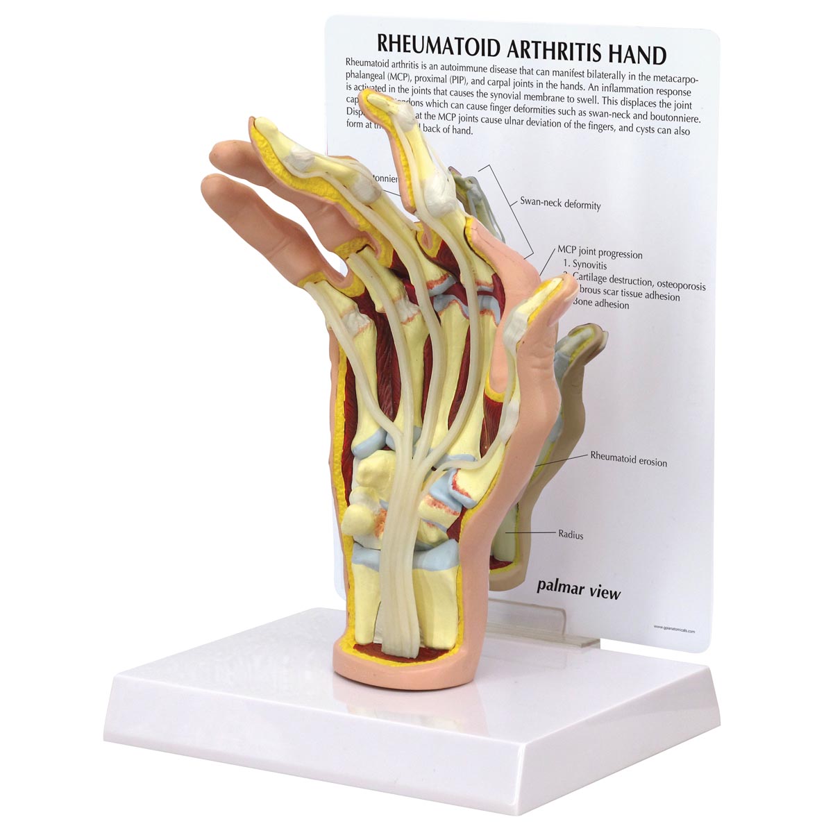 Rheumatoid Arthritis Hand Model - SEM Trainers