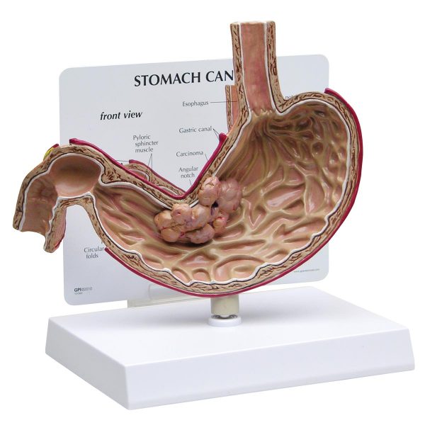 Gallstone Model - 3B Smart Anatomy - SEM Trainers