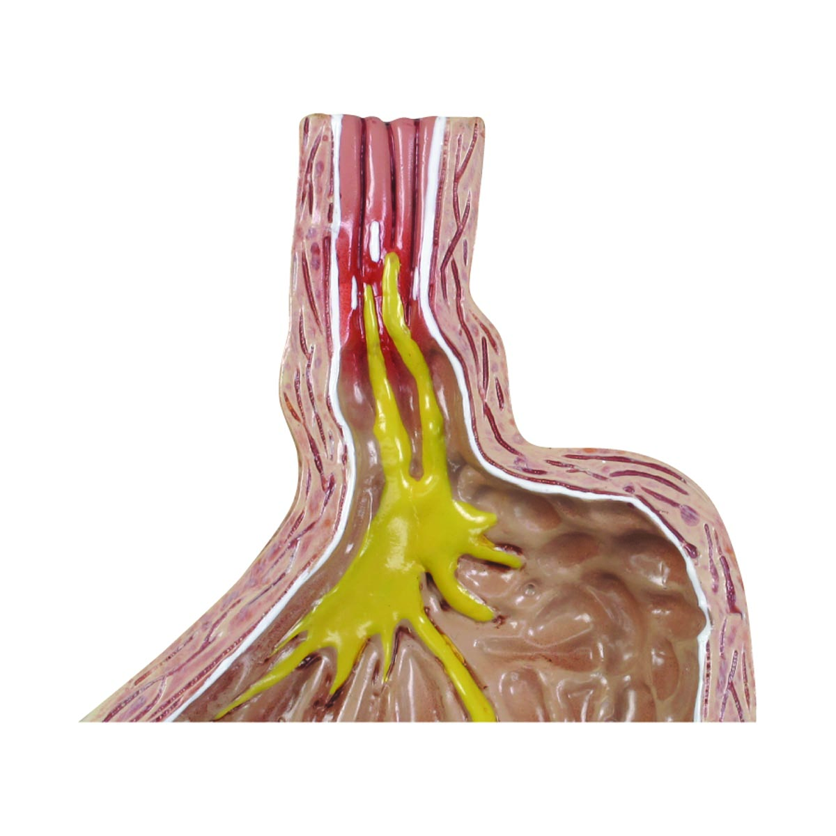 4-pc Gerd - (Gastro Esophageal Reflux Disease) - SEM Trainers