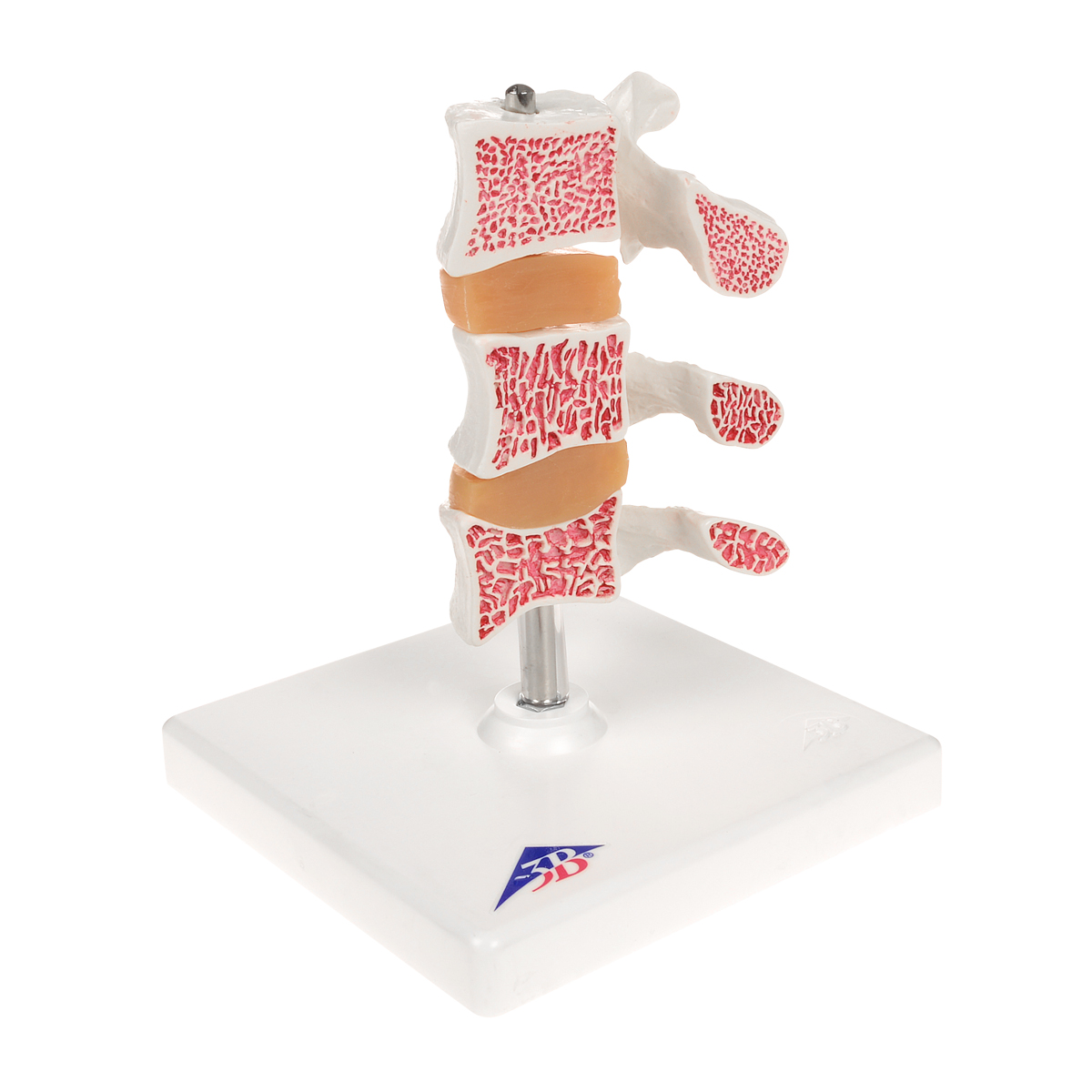 Deluxe Human Osteoporosis Model (3 Vertebrae with Discs ), Removable on Stand - 3B Smart Anatomy ...