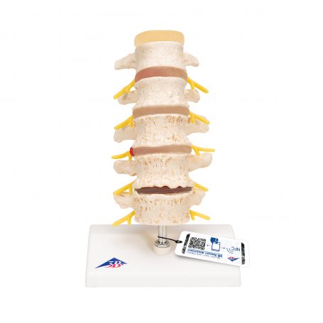 2 Human Lumbar Vertebrae with Prolapsed Disc, Flexibly Mounted - 3B Smart Anatomy - SEM Trainers