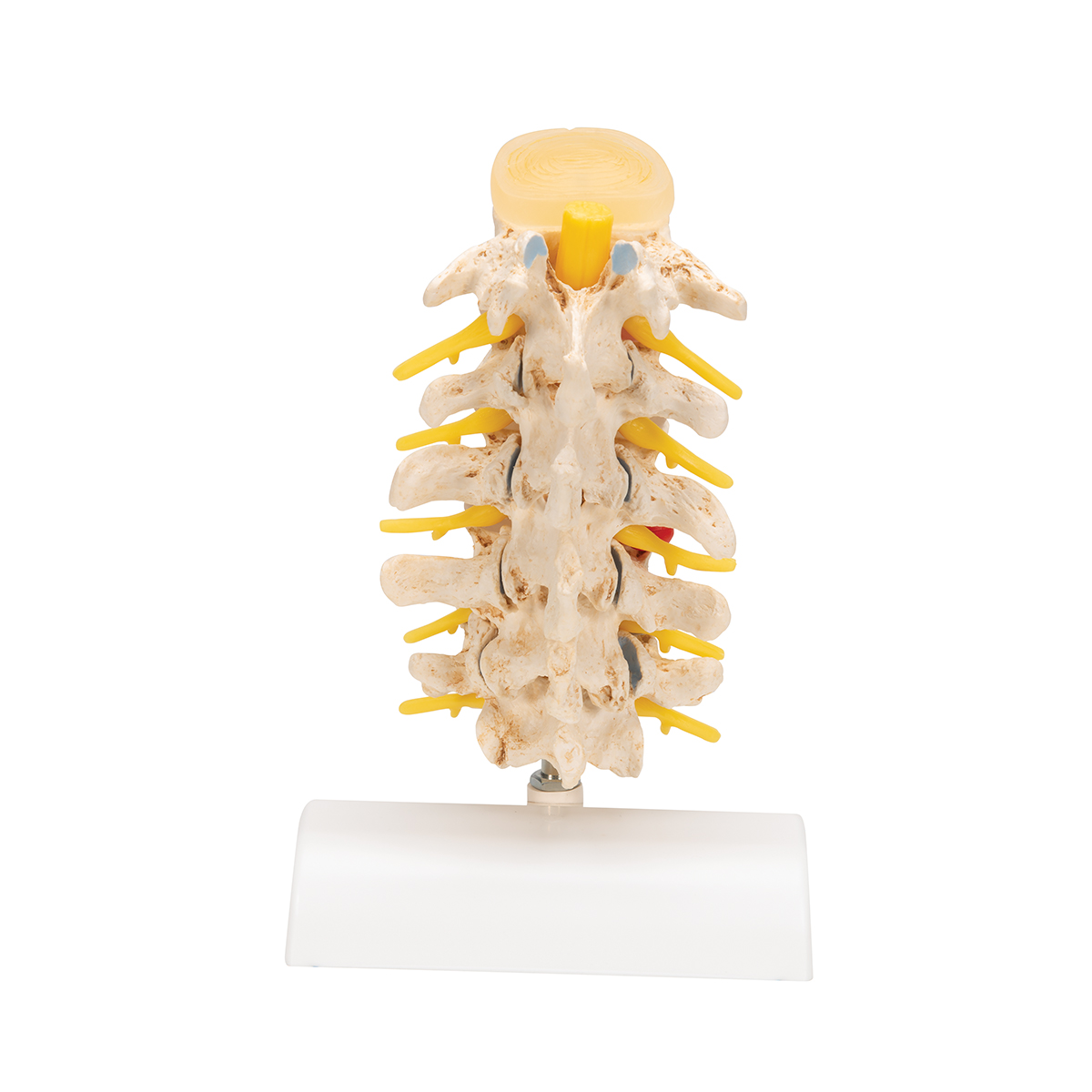 Stages of Disc Prolapse and Vertebral Degeneration - 3B Smart Anatomy ...