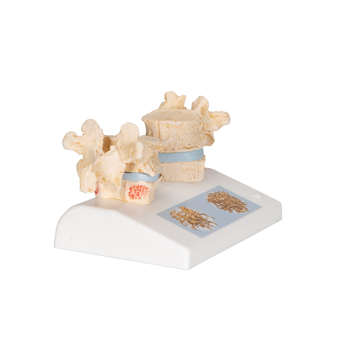 Osteoporosis Didactic Model - 3B Smart Anatomy - SEM Trainers