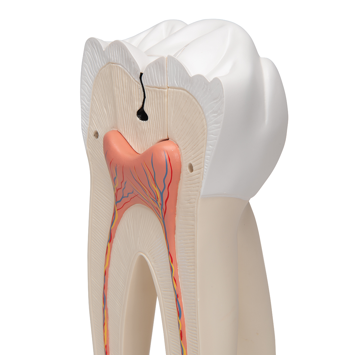 Giant Molar with Dental Cavities Human Tooth Model, 15 times Life-Size ...