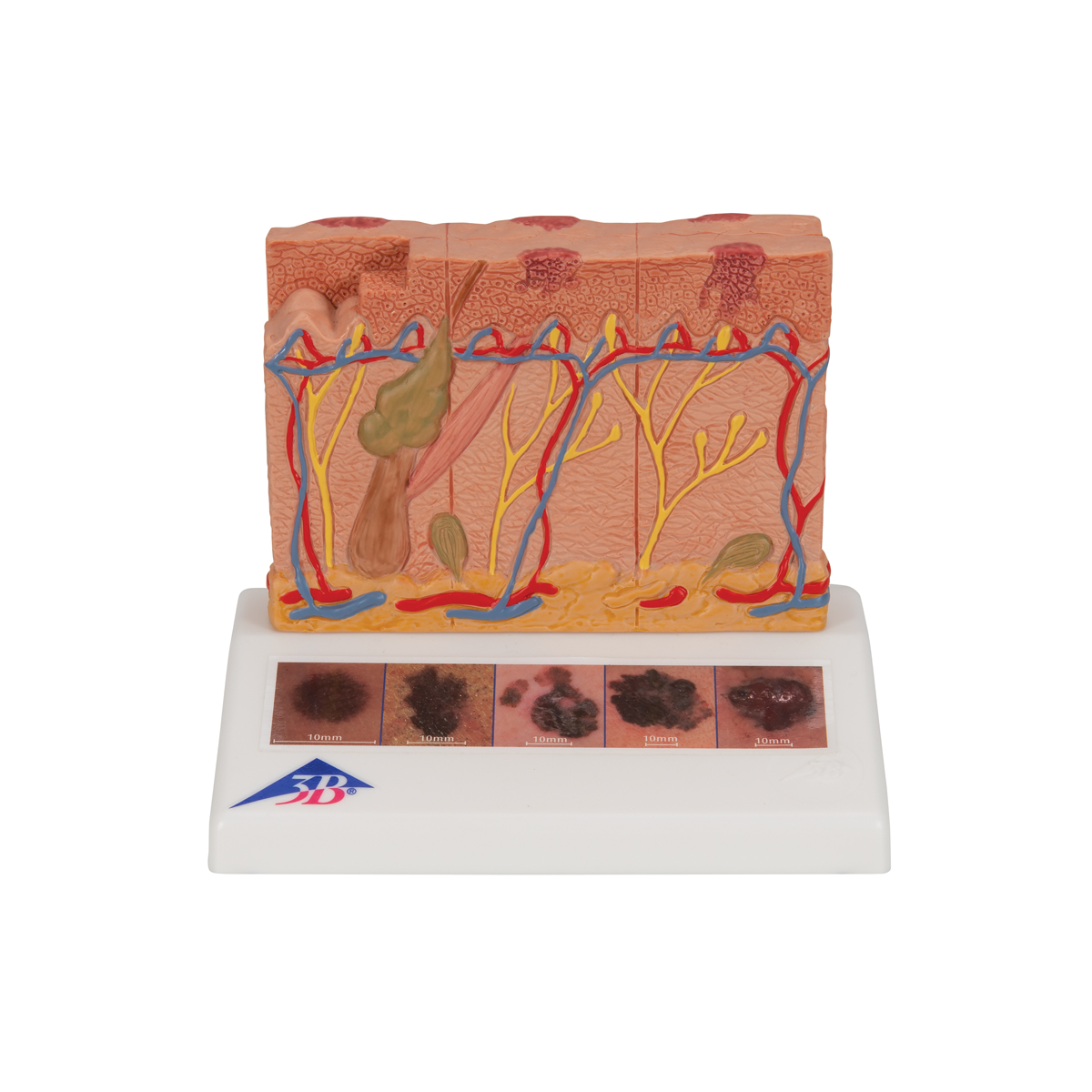 Skin Cancer Model with 5 stages, 8 times magnified - 3B Smart Anatomy ...