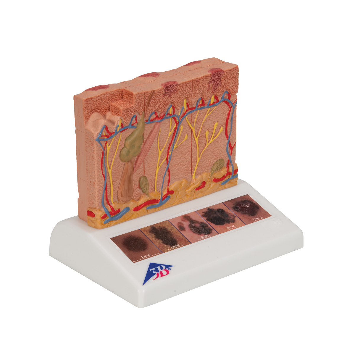 Skin Cancer Model with 5 stages, 8 times magnified - 3B Smart Anatomy ...