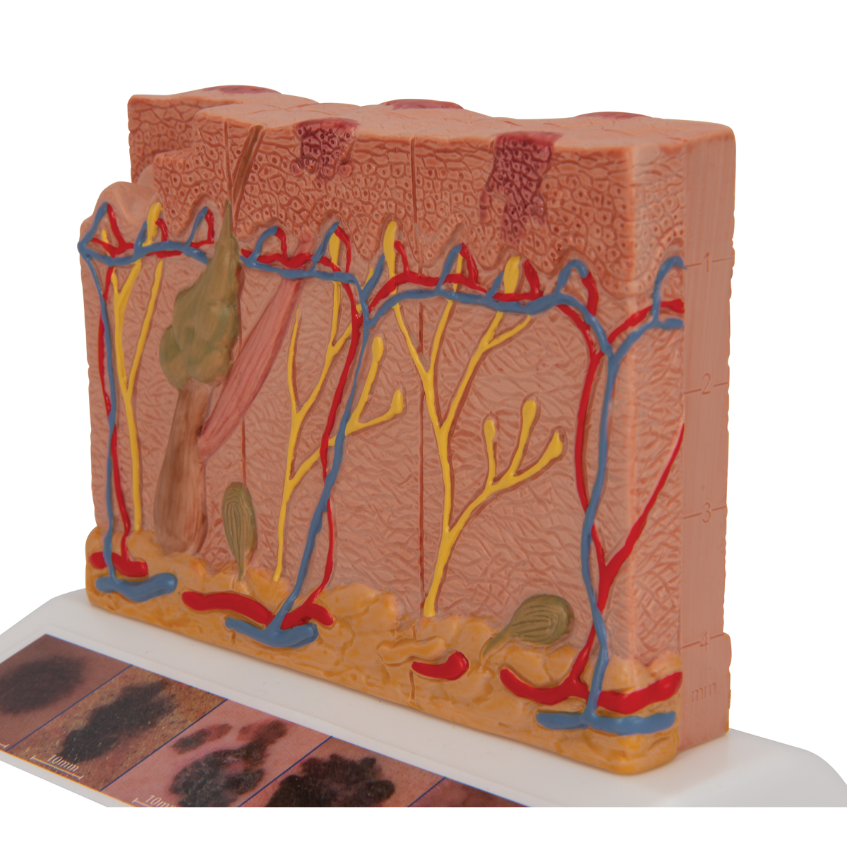 Skin Cancer Model with 5 stages, 8 times magnified - 3B Smart Anatomy ...