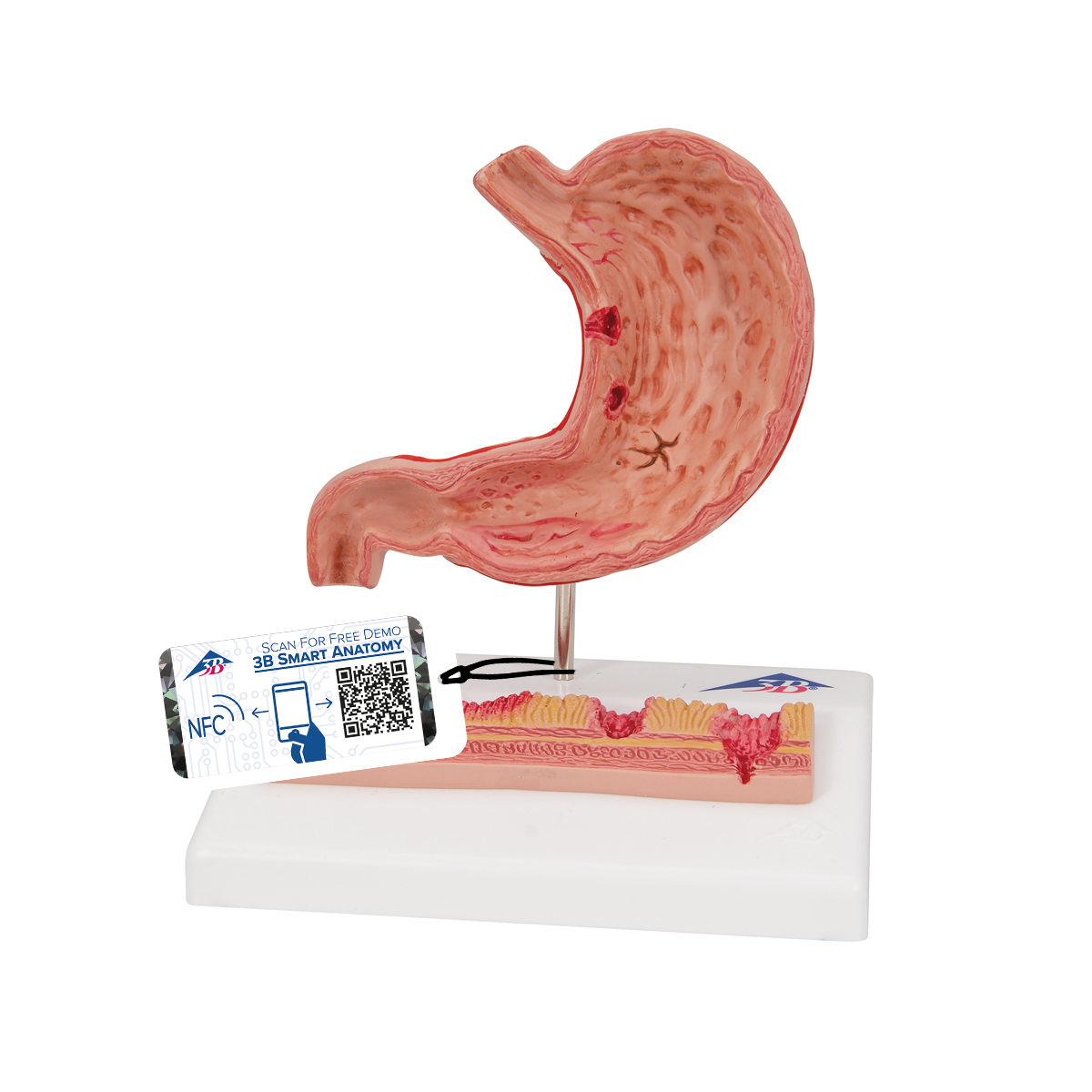 Human Stomach Section Model with Ulcers - 3B Smart Anatomy - SEM Trainers