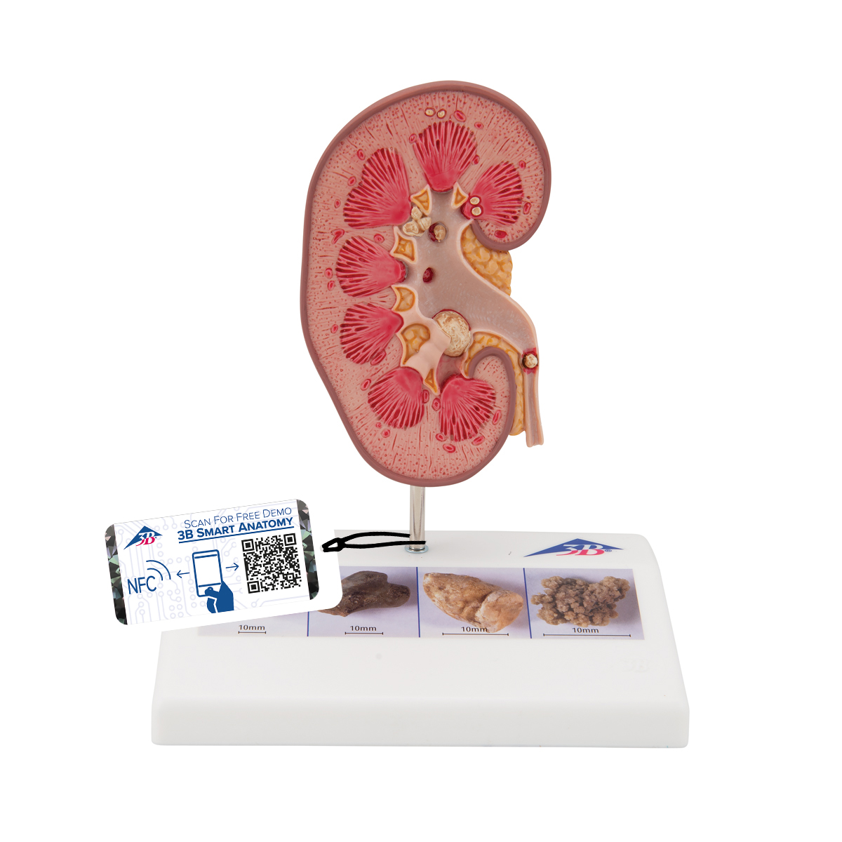 Kidney Stone Model - 3B Smart Anatomy - SEM Trainers