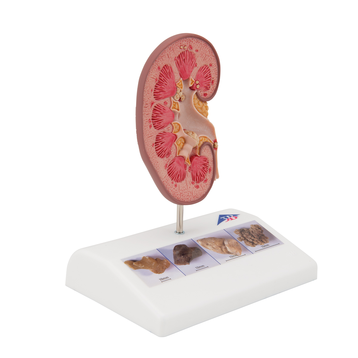 Kidney Stone Model - 3B Smart Anatomy - SEM Trainers
