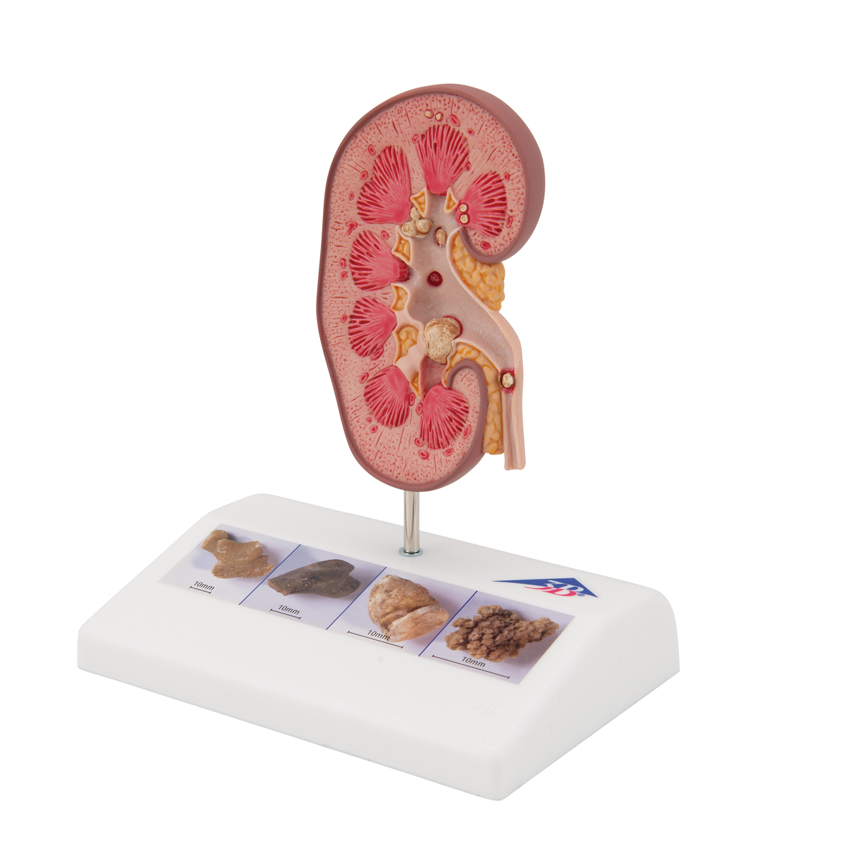 Kidney Stone Model - 3B Smart Anatomy - SEM Trainers