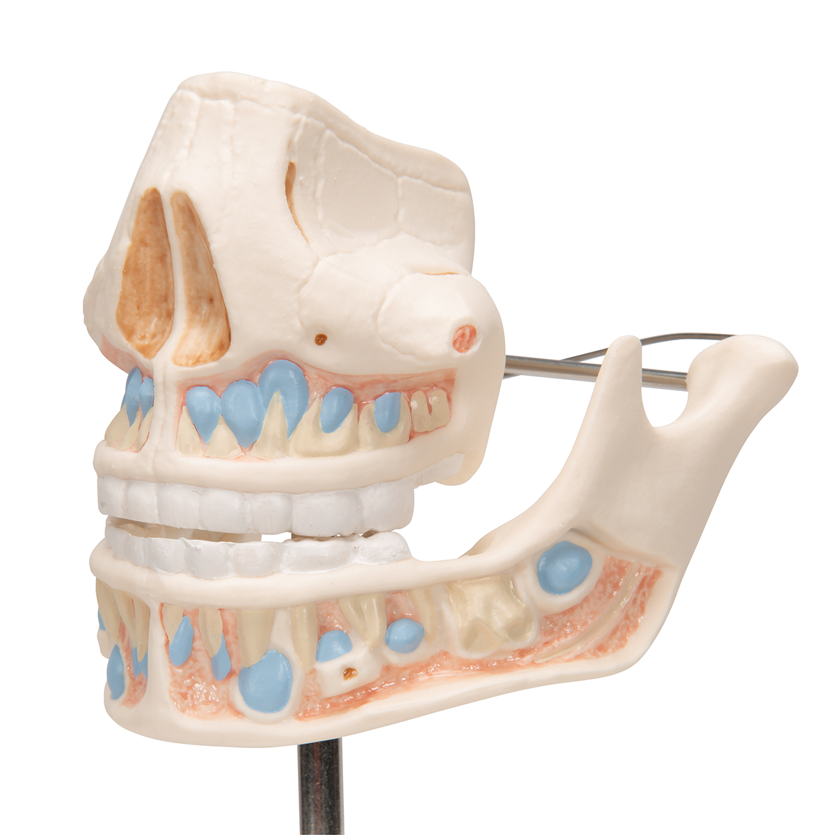Milk Denture Model with Remaining Teeth - 3B Smart Anatomy - SEM Trainers
