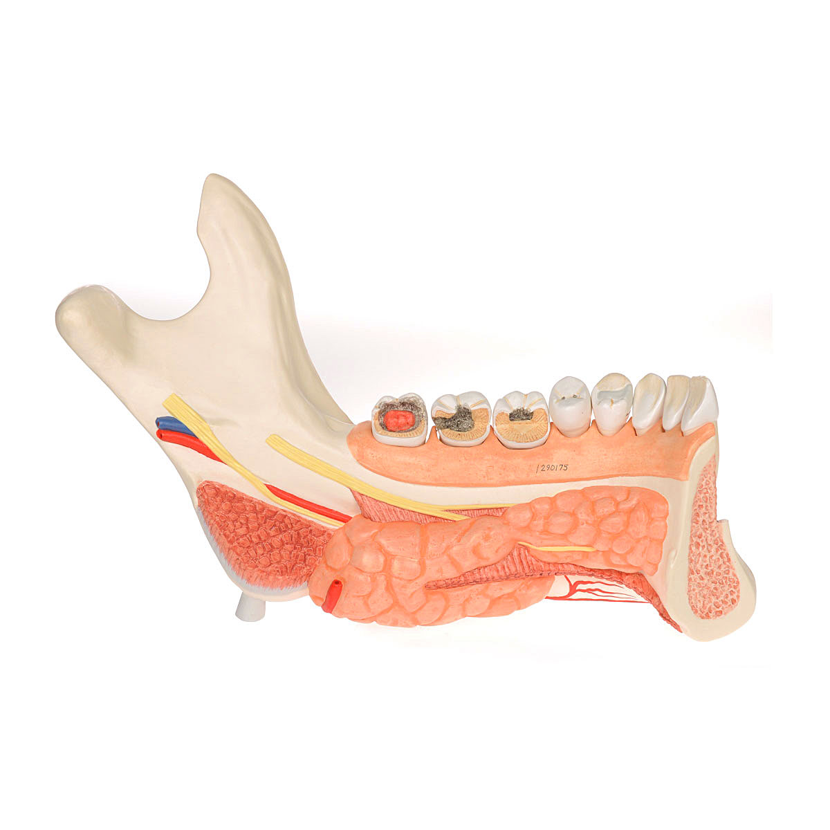 Comprehensive Lower Jaw Model (Left Half) with Diseased Teeth, Nerves ...