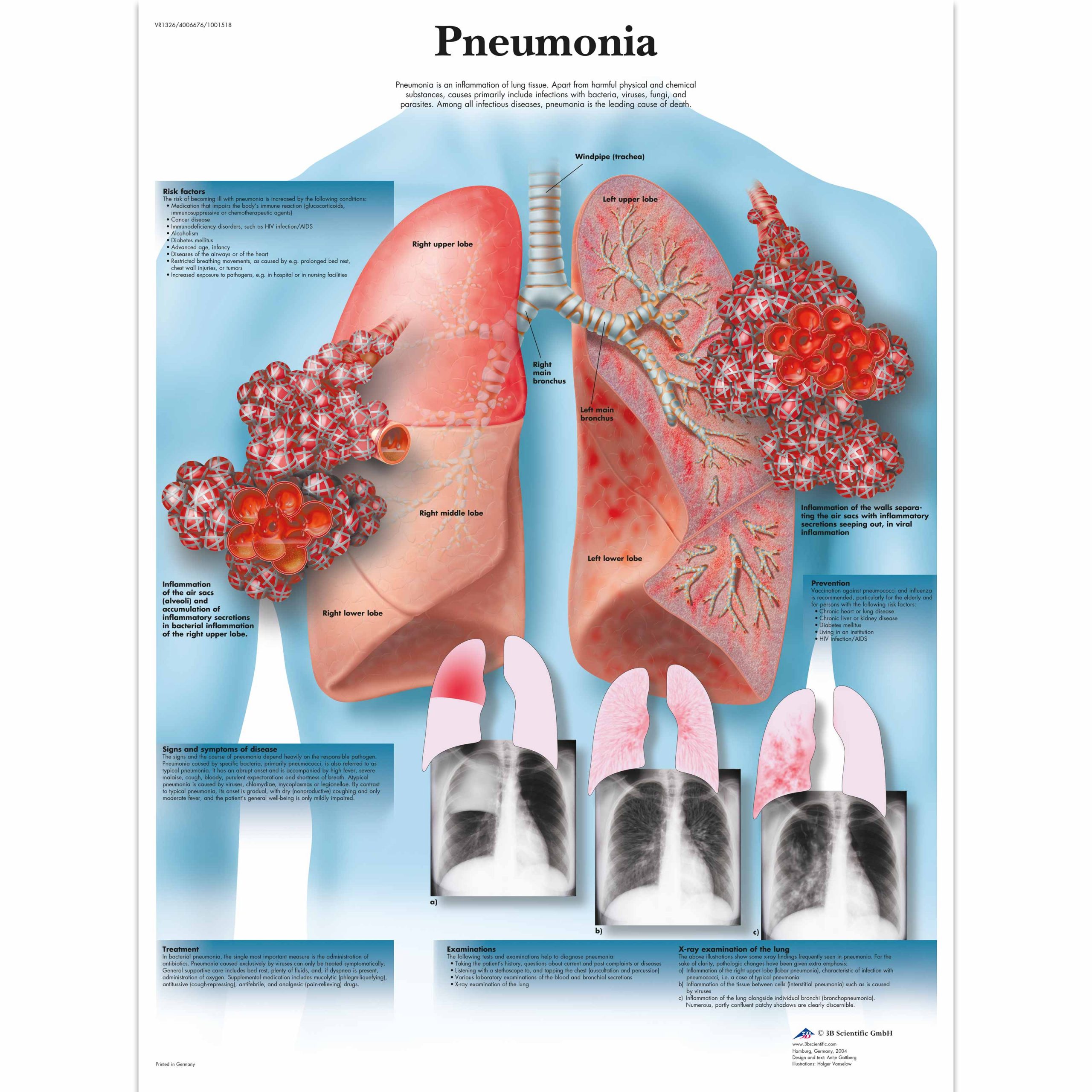 Pneumonia Chart - SEM Trainers