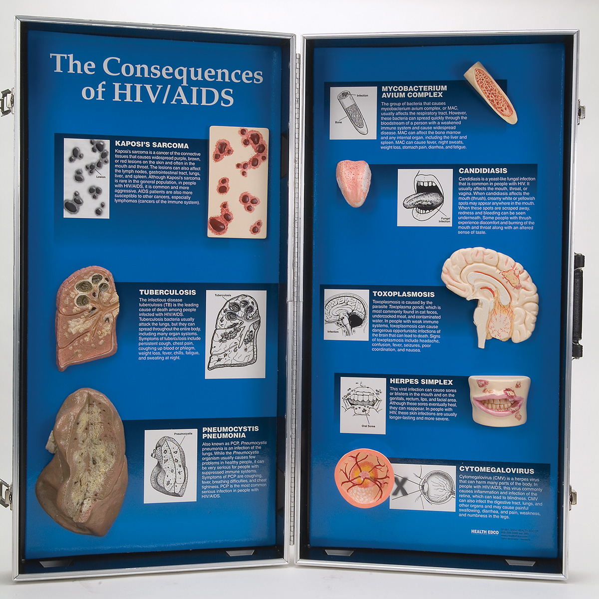 The Consequences of HIV/AIDS - 3D Display - SEM Trainers