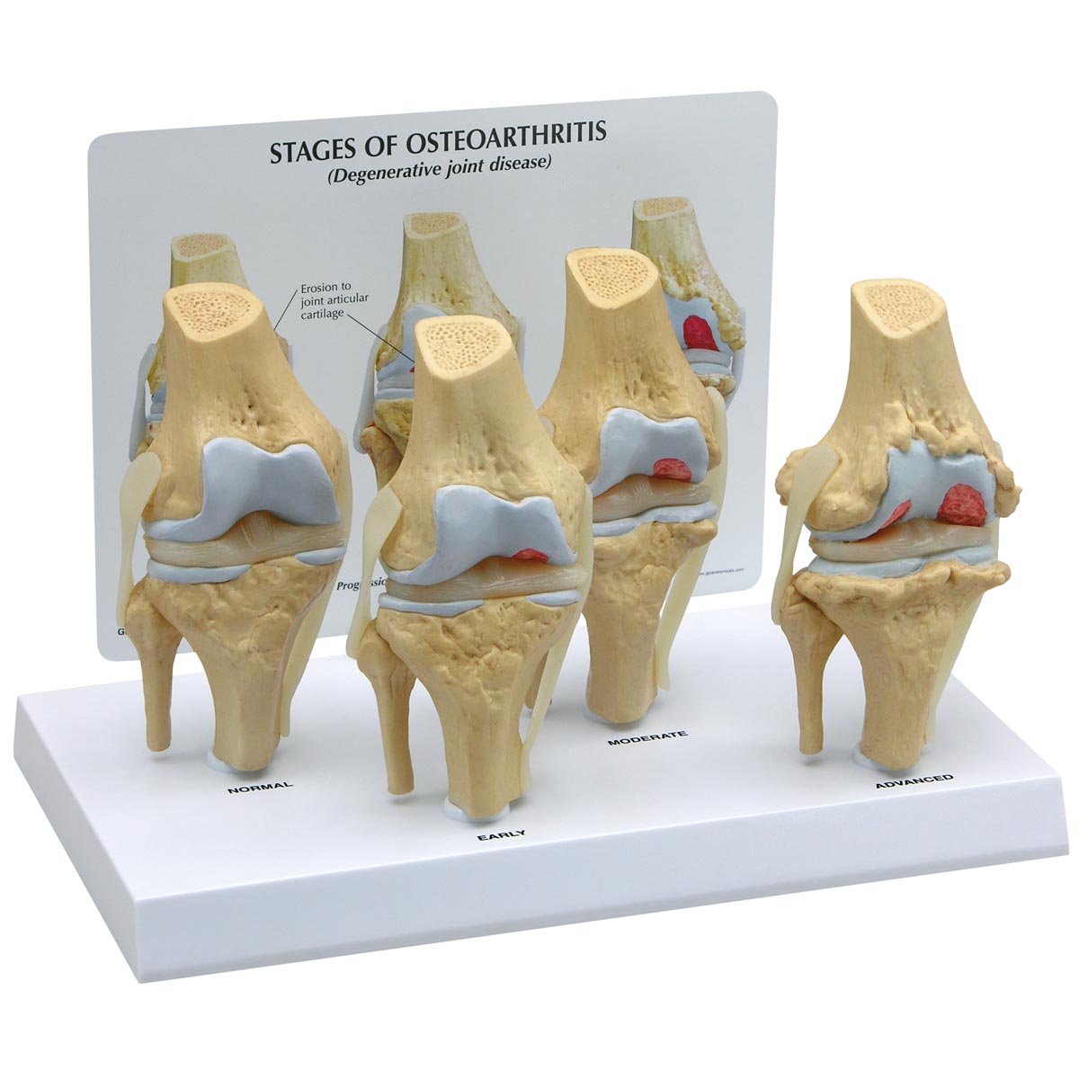 4-Stage Osteo Knee Model Set - SEM Trainers