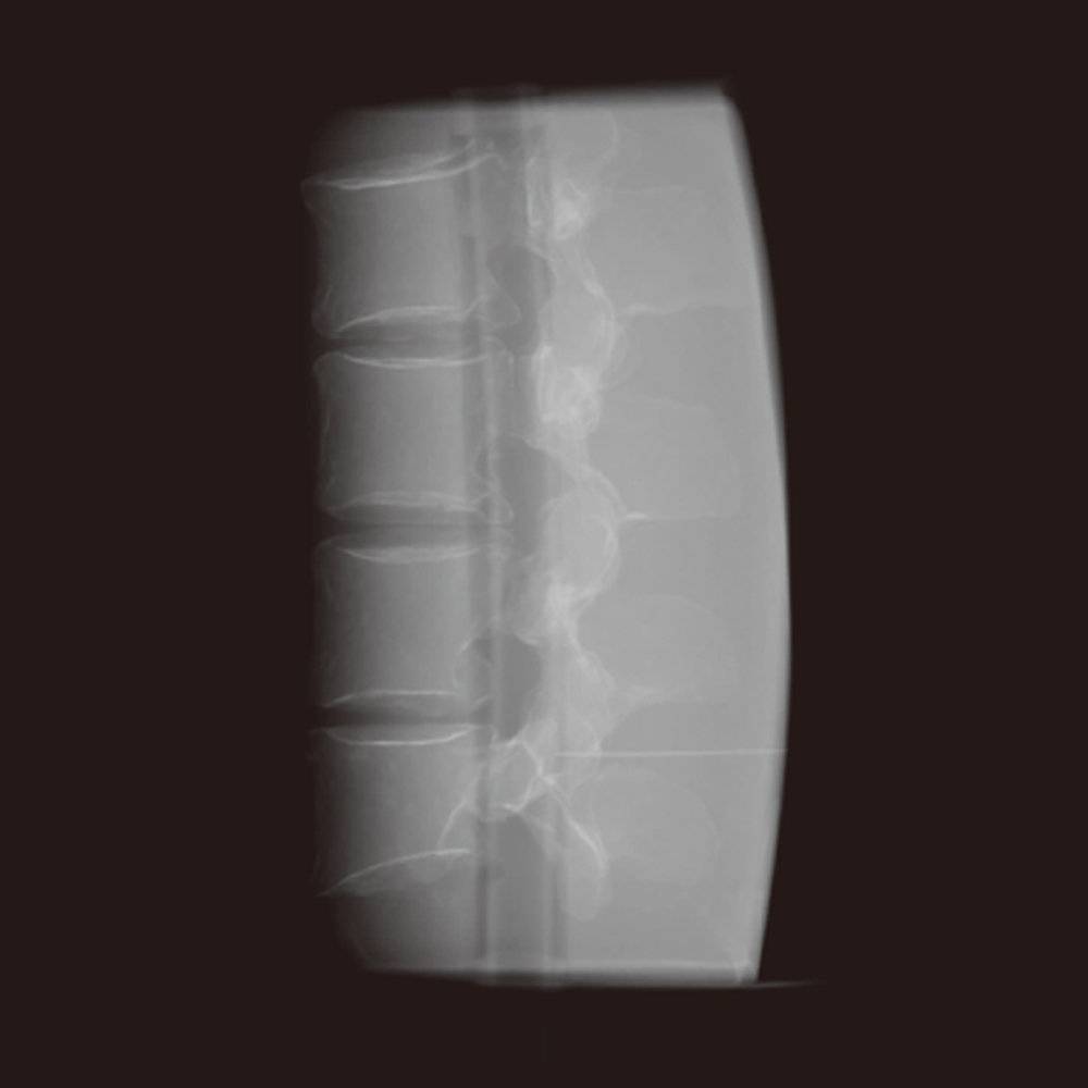 Lumbar Spine Fluoroscopy Training Phantom - SEM Trainers