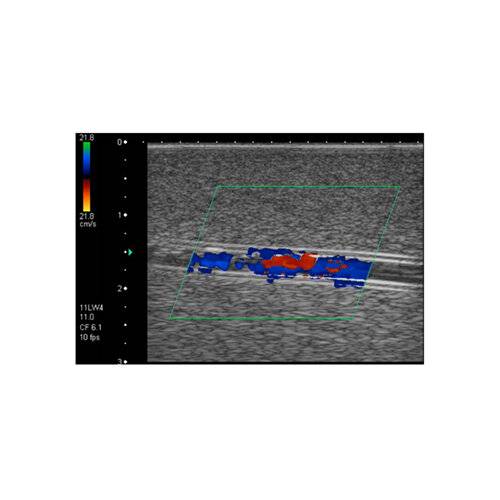 DVT (Deep Vein Thrombosis) Phantom - SEM Trainers