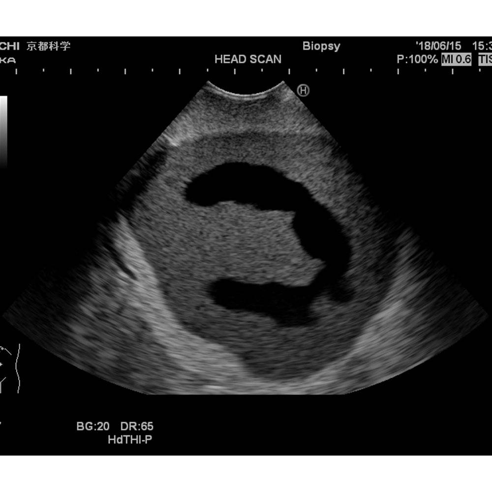 Ultrasound Neonatal Head Phantom Abnormal Type Sem Trainers